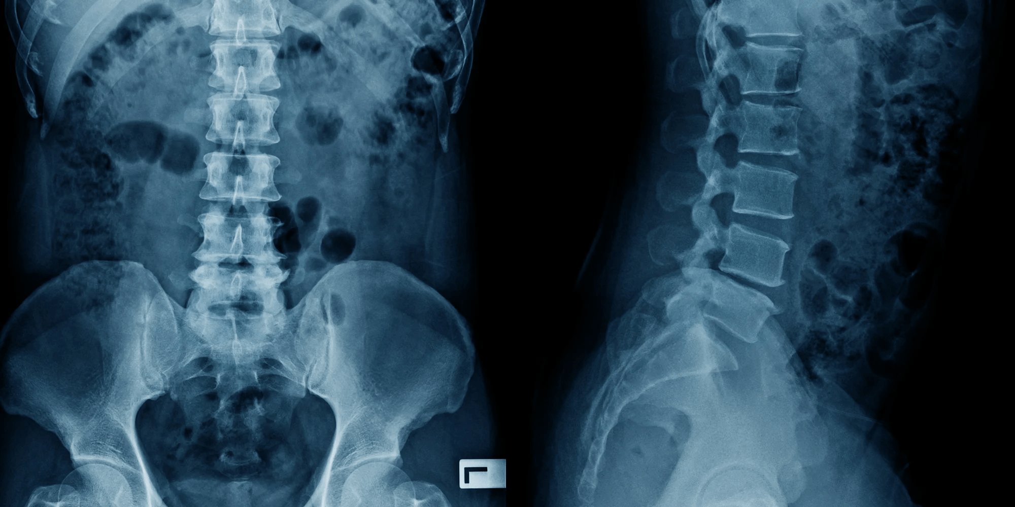 Radiografía de columna lumbar, 2 posiciones en Hospital Zambrano Helli ...