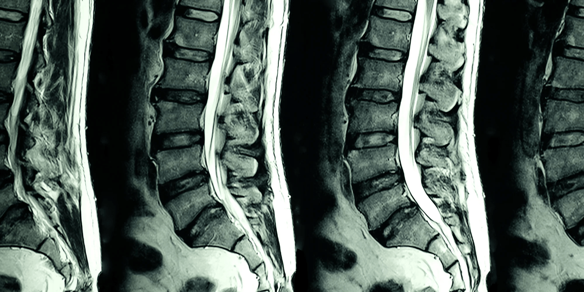 Resonancia magnética de columna lumbar simple en Hospital Zambrano Hel ...