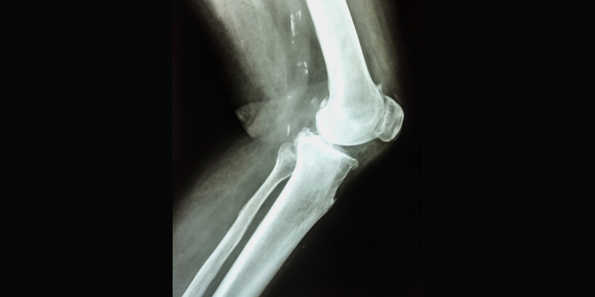 Radiografia De Rodilla